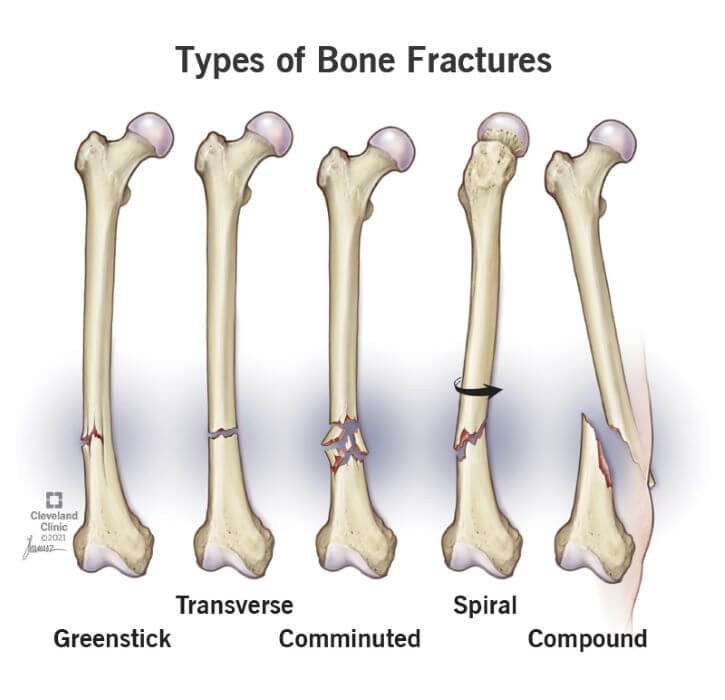 The Writer’s Guide to Broken Bones | Rebecca Shedd - Author